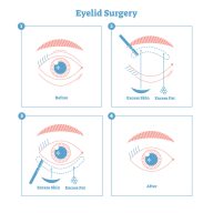 Exploring Eyelid Surgery For Men | Dallas, TX