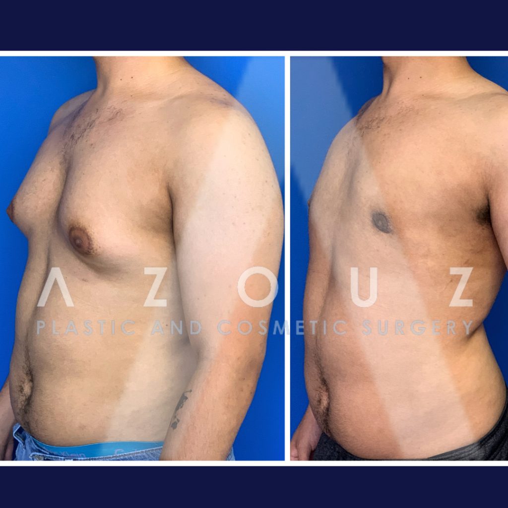 Stages of Gynecomastia | Azouz Plastic and Cosmetic Surgery